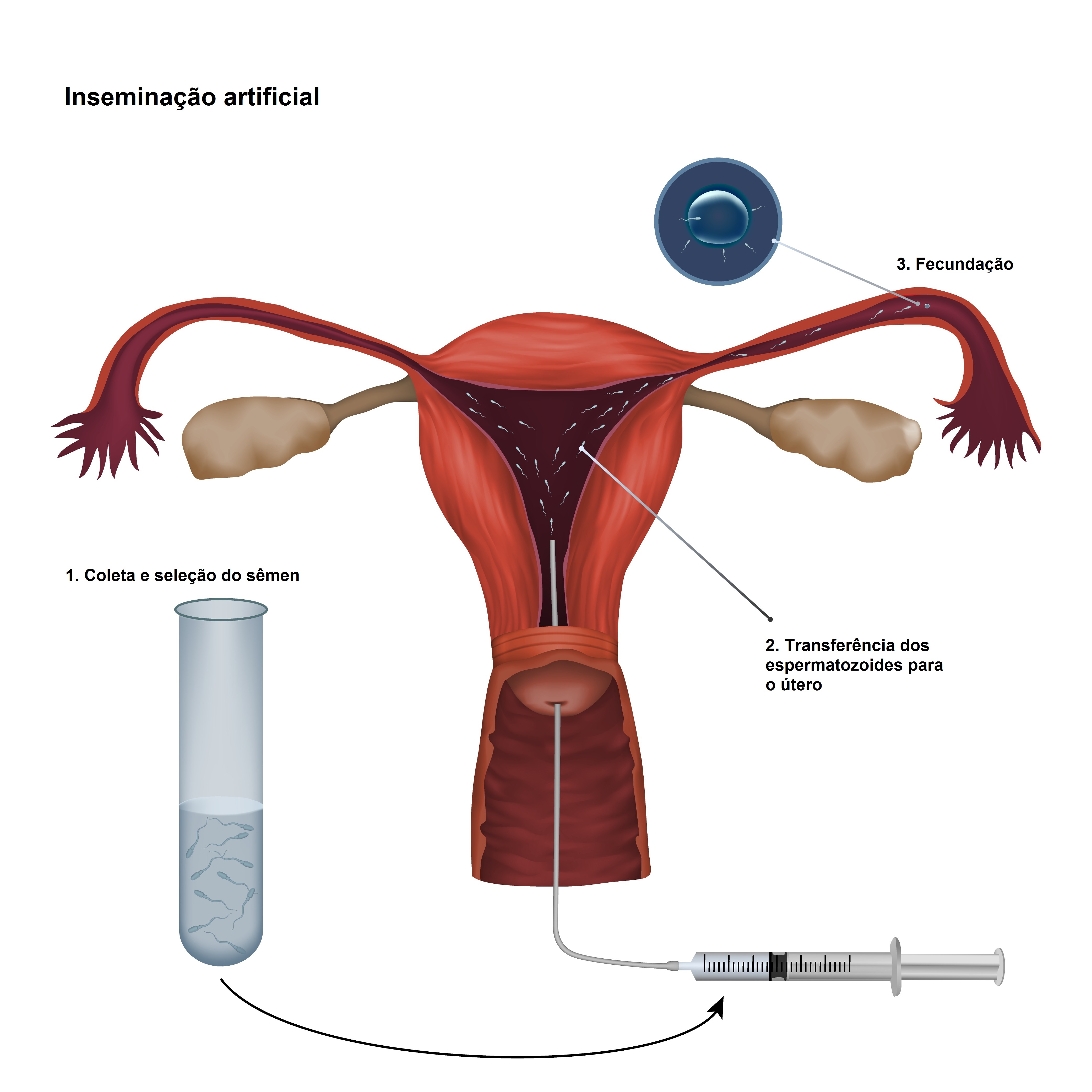 Inseminação Artificial X Fertilização In Vitro Fiv Entenda A