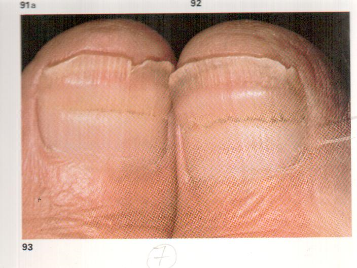 Unhas: Alterações nas unhas podem ser sinal de doença. Saiba como ...